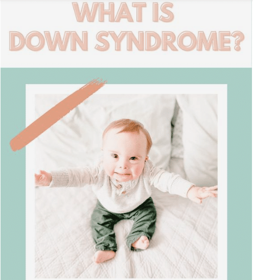 How Common is Down Syndrome? - Goally